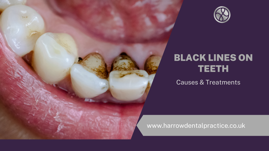Black Lines On Teeth: Causes & Treatments - Harrow Dental Practice Blog